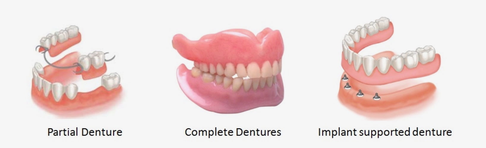 Dentures Chiswick | False Teeth | Replace Missing Teeth Chiswick